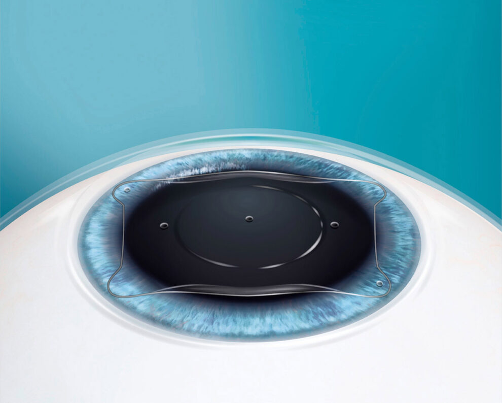 EVO ICL in Louisville | Vision Correction | Intraocular Lenses