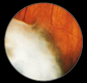 Pars Planitis | Bennett & Bloom Eye Centers